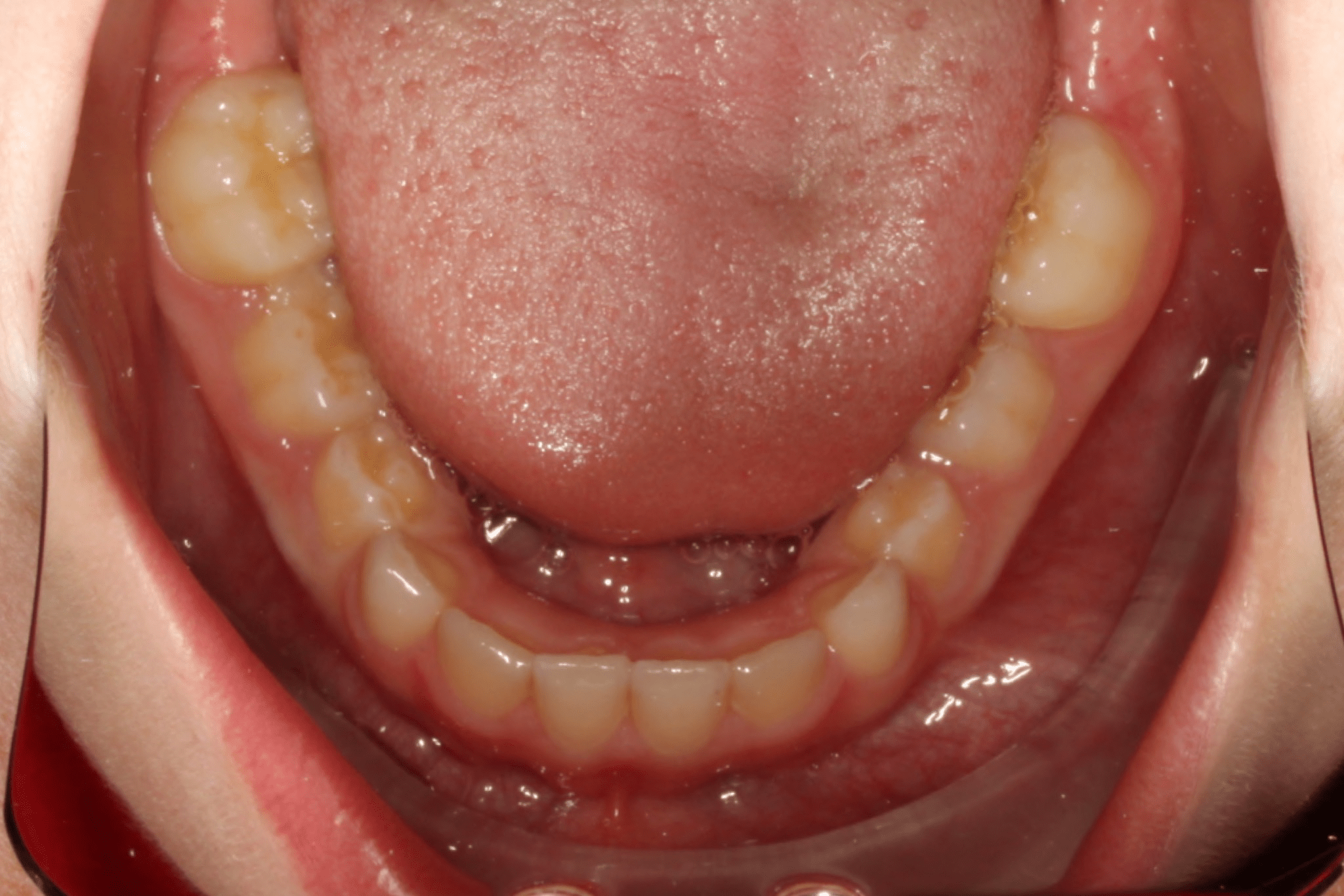 Before & After Orthodontic Photos Somerville NJ | Expanders & Braces