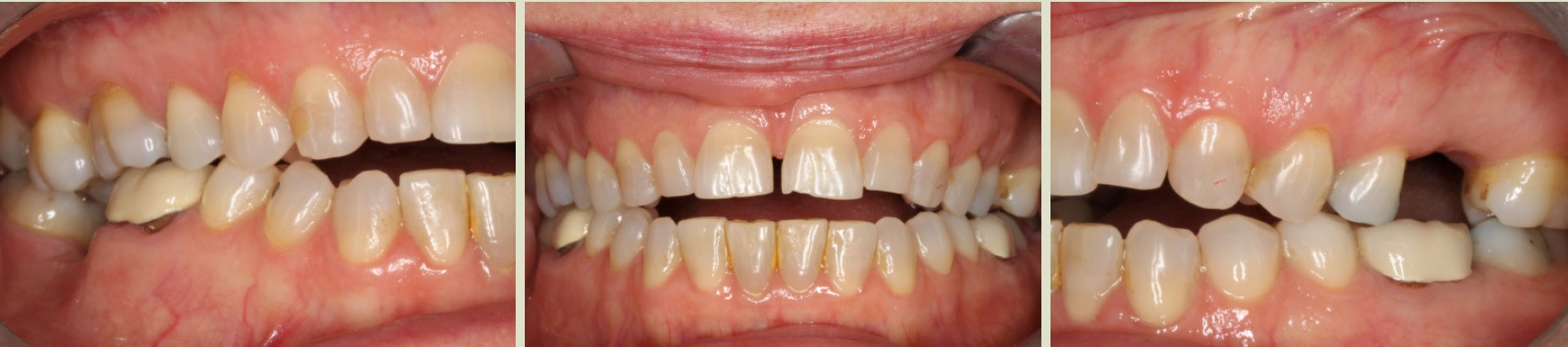 Before & After Orthodontic Photos Somerville NJ | Invisalign Corrections